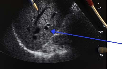 Ultrasound Guided Peripheral IV Insertion - NurseAvatar
